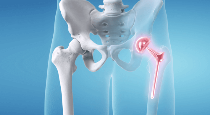 Operating Room:2gjgawp6t74= Hip Replacement Surgery - Fusion Power Tech